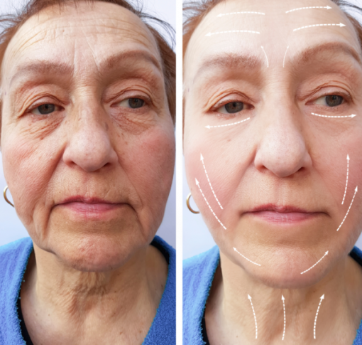 Faden Lifting | Privatpraxis Laurensberg